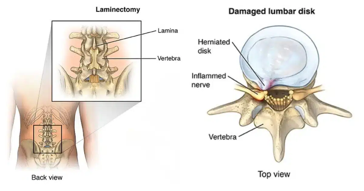 Laminectomy Surgery And Treatment Procedure Operation 9529