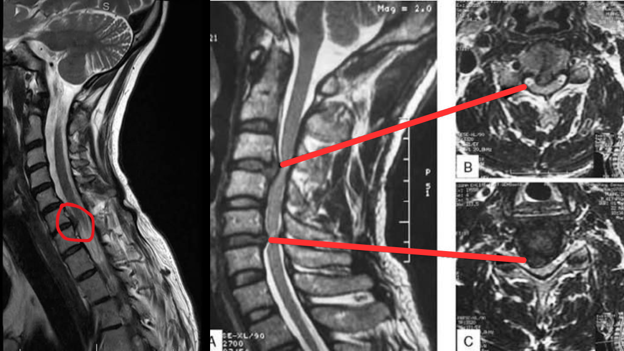 Cervical Disc Herniation & Neck Slipped Disc | Symptoms & Treatment