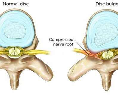 Slipped Disc: Causes, Symptoms, Treatment & Full Recovery Guide